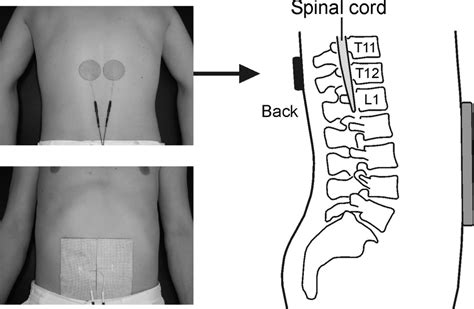 Electrode Placement For Transcutaneous Spinal Cord Stimulation