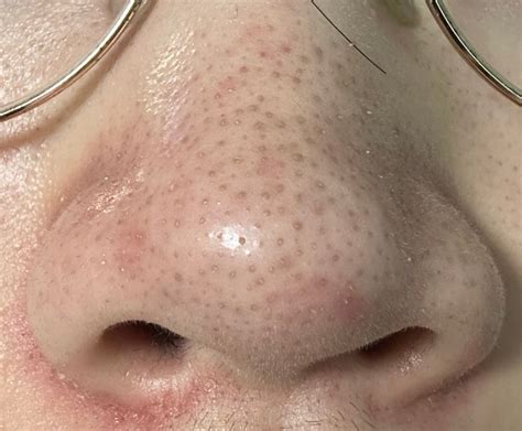 딸기코 어떻게 해결할수있을까요 지식in