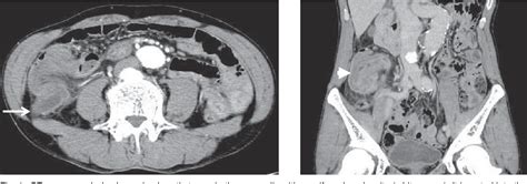 Figure 1 From A Case Of Low Grade Appendiceal Mucinous Neoplasm Performed With Laparoscopic