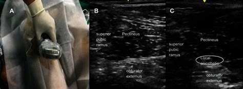 Ultrasound Guided Proximal Obturator Nerve Block A Patient Is In