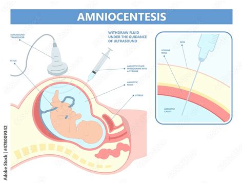 Amniocentesis Diagnostic Test Treat Lab Analysis Dna Gene Screen Risk