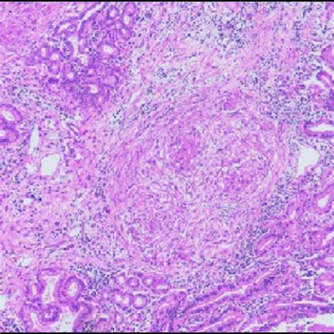 Microphotograph Of The Gallbladder Showing Gallbladder Mucosa And Download Scientific Diagram