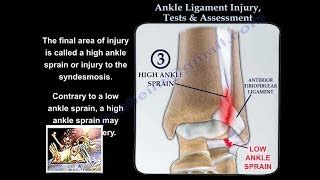 Ligament Ankle Tear