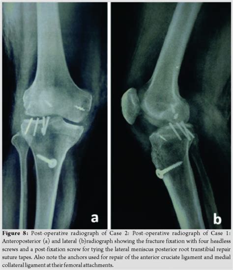 Anterior Cruciate Ligament Rupture With Medial Collateral Ligament Tear