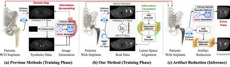 Reducing Ct Metal Artifacts By Learning Latent Space Alignment With Gemstone Spectral Imaging Data