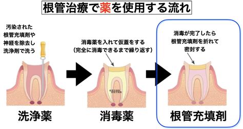 現役歯科医解説！根管治療の薬がもたらす不安や痛みの原因と対処法！