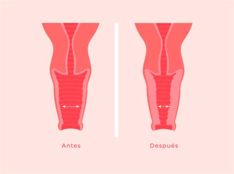 Vaginal Rejuvenation Treatments Ginecolaser