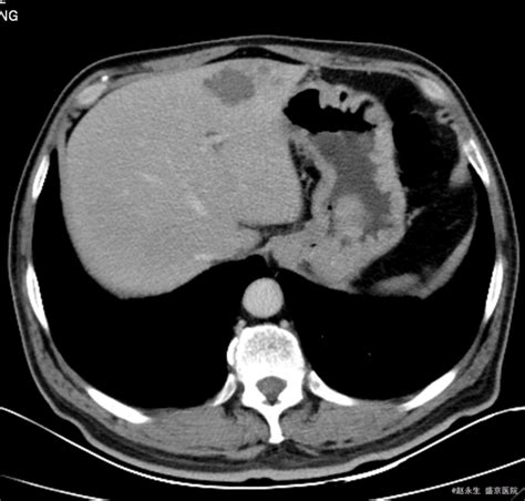 胃癌并肝脓肿1例 医联