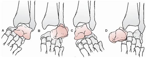 Fractures Of The Metacarpals And Phalanges Teachme Orthopedics