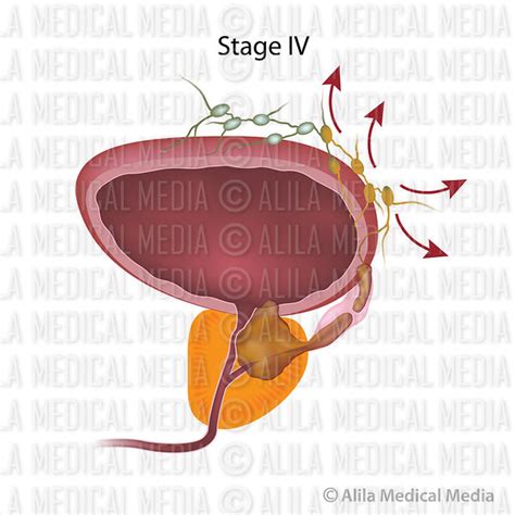Alila Medical Media Stage 4 Of Prostate Cancer Medical Illustration