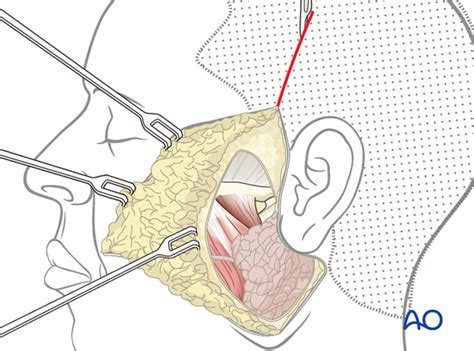 Temporalis Muscle Transposition For Irreversible Paralysis Midface And Mouth Temporalis Muscle Transposition For Irreversible Paralysis Midface And Mouth