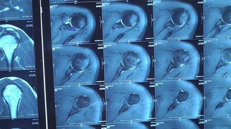 Understanding Rotator Cuff Injuries Symptoms Causes And Prevention