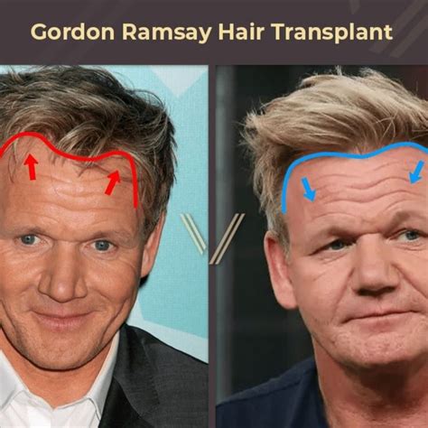 Gordon Ramsay Before After Plastic Surgery Read The