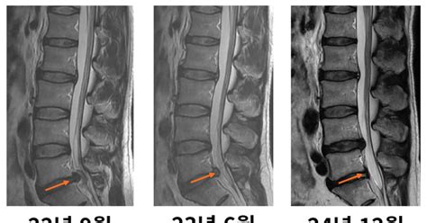 허리디스크 수술 없이 치료 가능성 10 라면 당신의 선택은 황상필 원장의