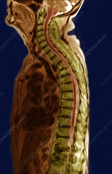 Lumbar Compression Fracture Mri Stock Image C0271377 Science