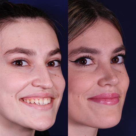 【upturned Nose Complete Guide 2025】