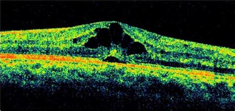 Diabetic Maculopathy Oct