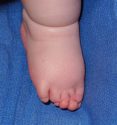 Amniotic Constriction Band Congenital Hand And Arm Differences