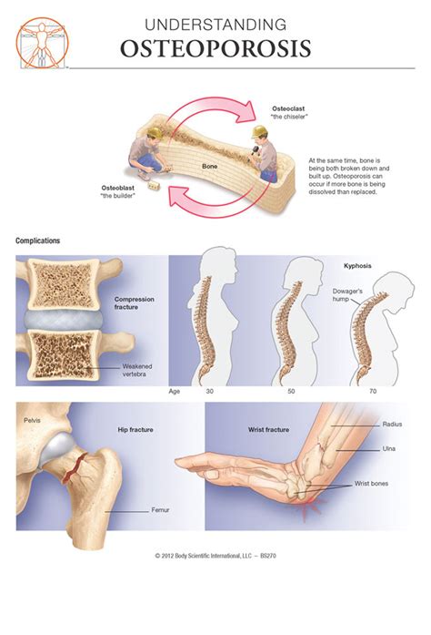 Osteoporosis Anatomical Wall Chart Bsi Catalog