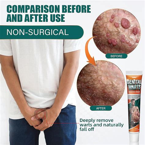 Men Private Parts Wart Remover Genital Warts Gentle Removal Cream For