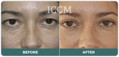 Blepharoplasty Vs Brow Lift Understanding The Difference And Choosing