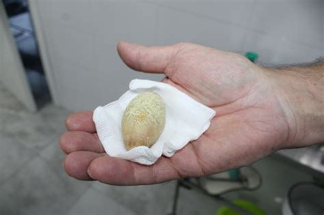 Подмосковные врачи спасли пенсионерку с огромным камнем желчного пузыря в кишечнике