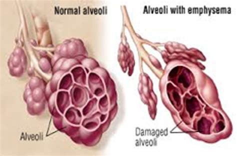 Bronchial Inflammation