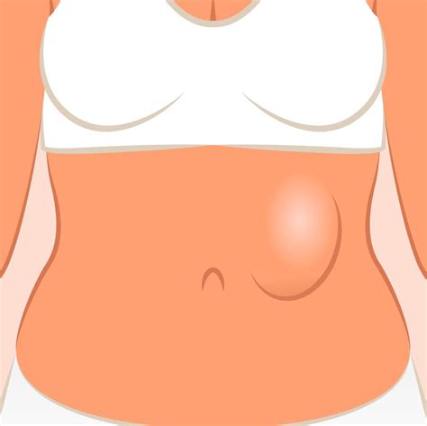 Female Real Hernia Atelier Yuwaciaojp