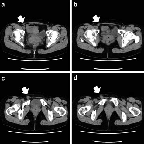 Pelvic Ct Axial An Approximately 18×16 Mm Soft Tissue Structure With Download Scientific