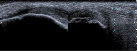 Figure 2 From Traction Apophysitis Of The Knee A Case Report