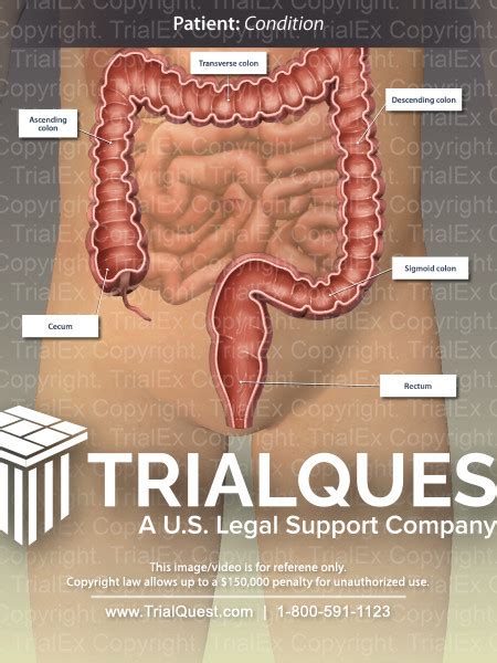 Normal Colon Anatomy Illustration Trialquest Inc