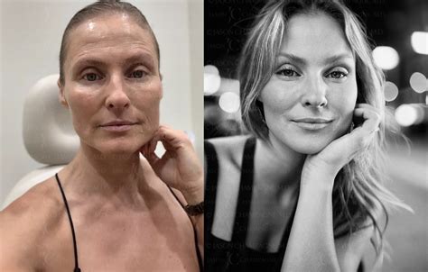 Botox® And Dysport® Before And After Gallery Dr Jason Champagne