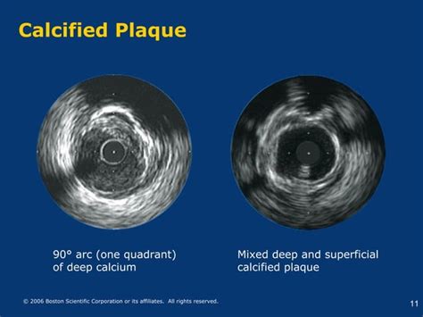 Ivus Image Interpretation And Analysis Ppt