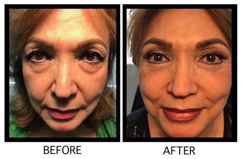 Patient 55495939 Blepharoplasty Eyelid Surgery Before And After