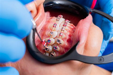 What Are Partial Braces Benefits Treatment And Process