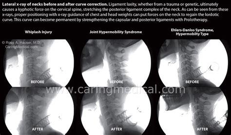 Vagus Nerve Compression In The Neck Symptoms And 45 Off