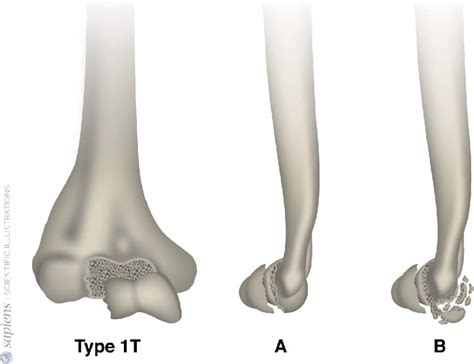 Fractures Of The Humeral Trochlea Case Presentations And Review