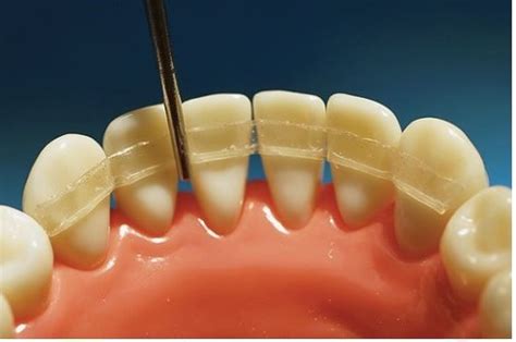 Loose Teeth Periodontal Splinting Riverbank Modern Dentistry