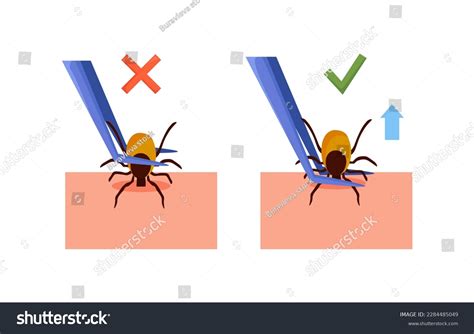 Removing Encephalitis Ticks After Bite How Stock Vector Royalty Free 2284485049 Shutterstock