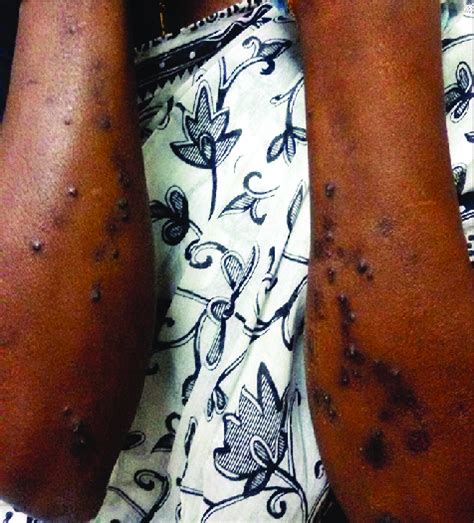 Keratotic Papules With Central Keratin Filled Crater Mainly On The