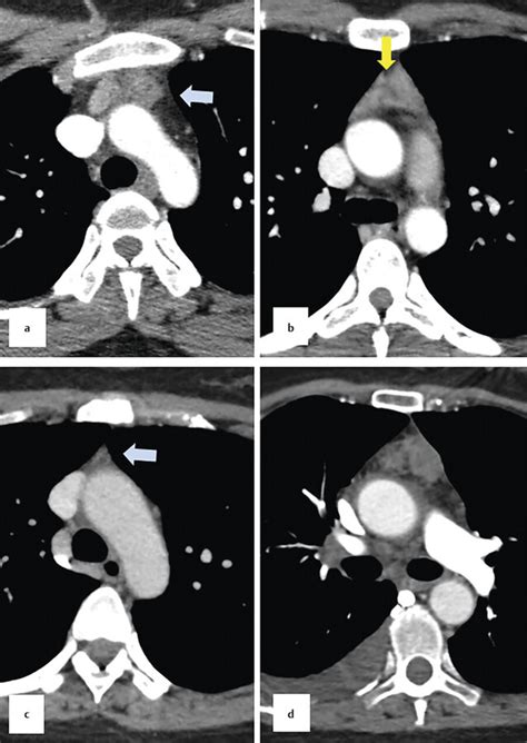 3 Mediastinum And Thymus Radiology Key