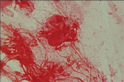 Gram Negative Diplococci Gonorrhea