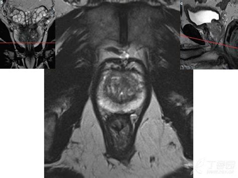 前列腺解剖及功能 丁香园论坛