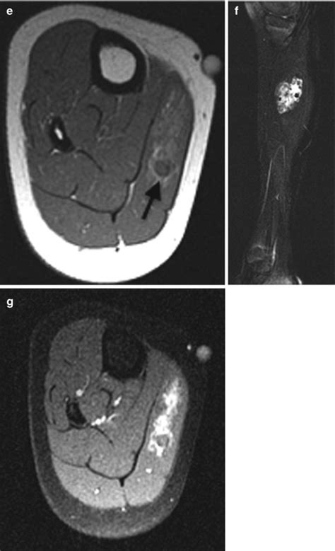Soft Tissue Masses Radiology Key