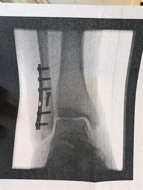 Ankle Orif Done R Orif