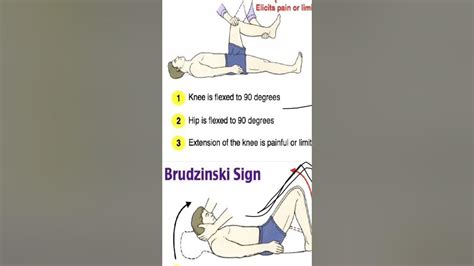Kerning Sign👨‍⚕ Brudzinski Sign Sign Of Meningitis Meningitis