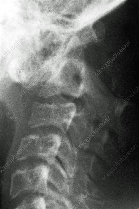 Dislocation Of C1 And C2 Vertebrae Stock Image C030 5676 Science
