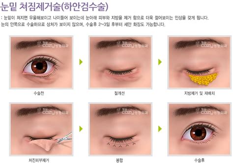 눈밑주름제거수술비용 네이버 블로그