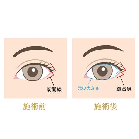 目尻切開｜自由が丘ウェルエイジングビューティークリニック美容外科・美容皮膚科・婦人科形成｜東京・目黒区自由が丘