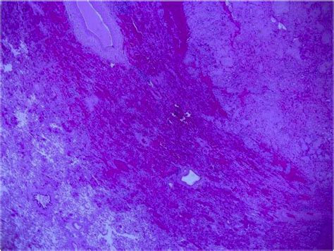 Low Power Image Showing Normal Lung Vs Amyloid Download Scientific